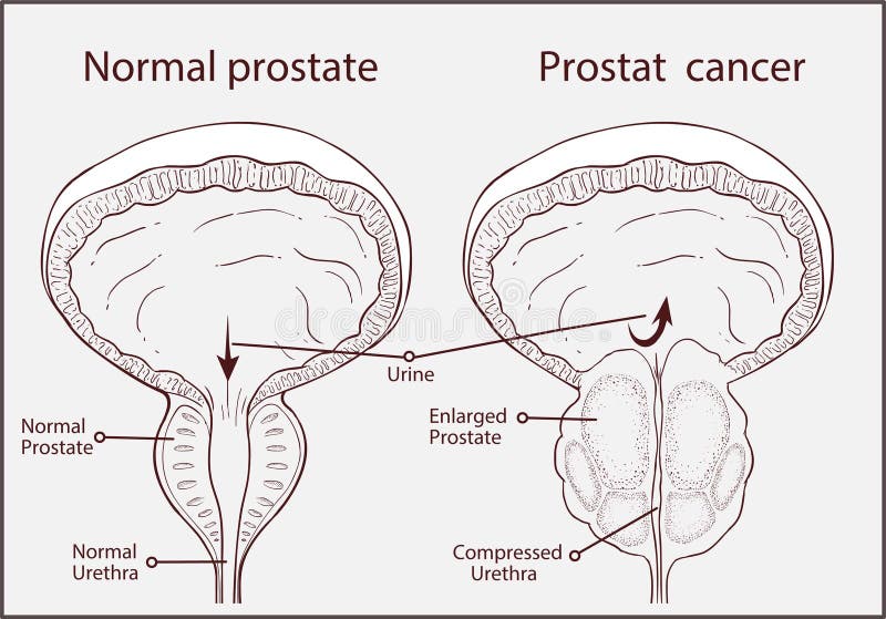 Prostatic hypertrophy stock vector. Illustration of male - 92093349