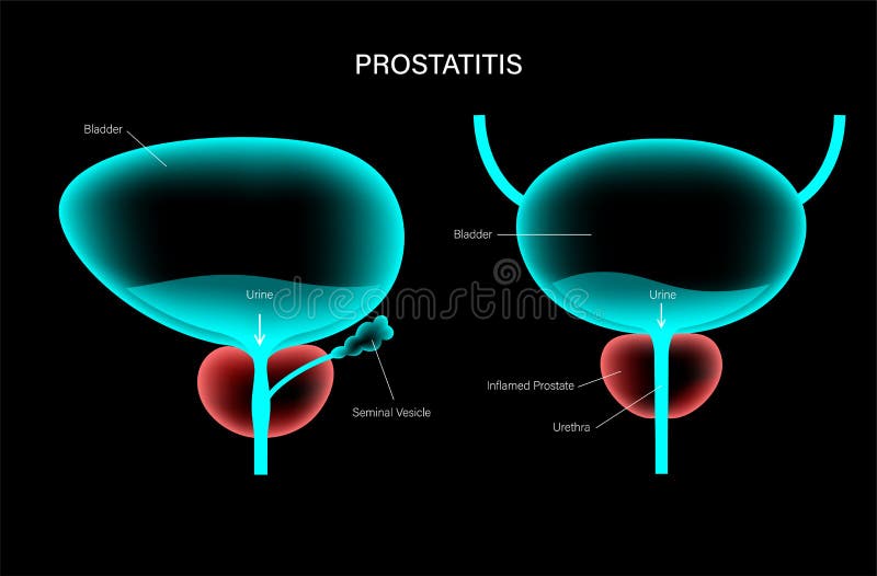 Prostatitis Inflammation Problem Stock Vector - Illustration of chronic ...
