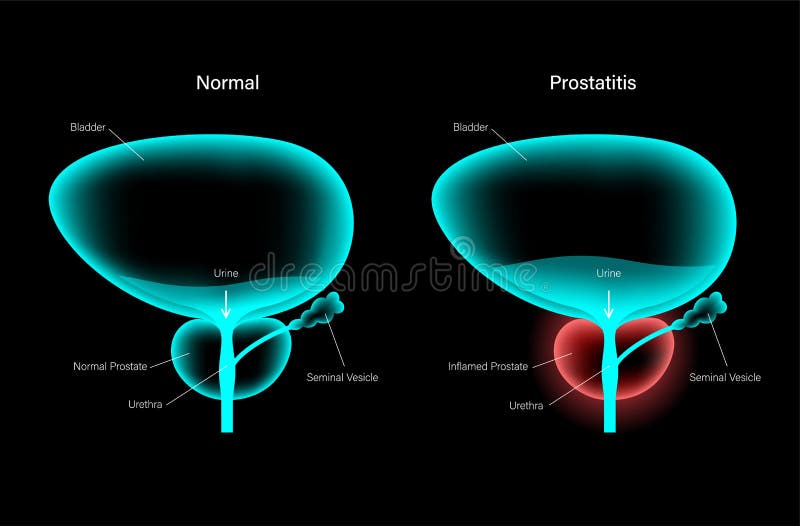 Prostatitis Inflammation Problem Stock Vector - Illustration of chronic ...