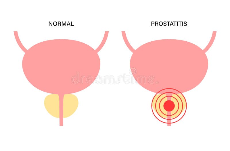 Prostate Stock Illustrations – 7,143 Prostate Stock Illustrations ...
