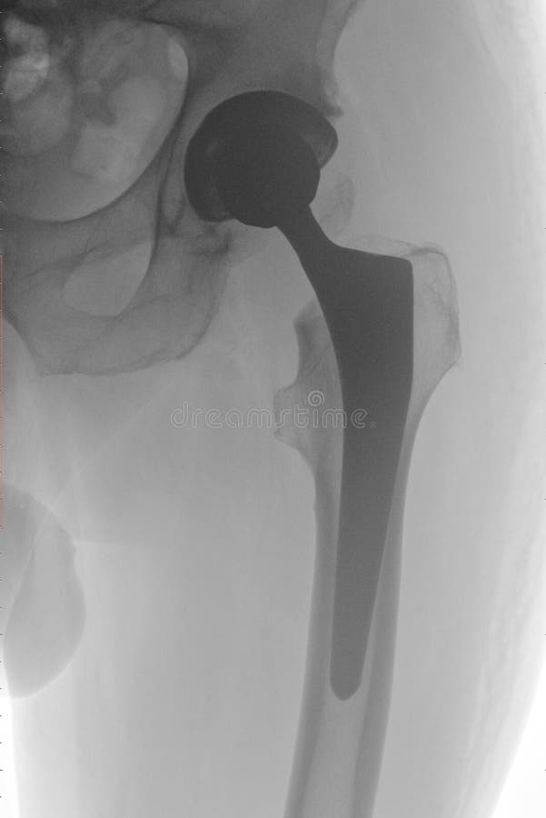 Prosthetic hip replacement stock photo. Image of fake - 23397160
