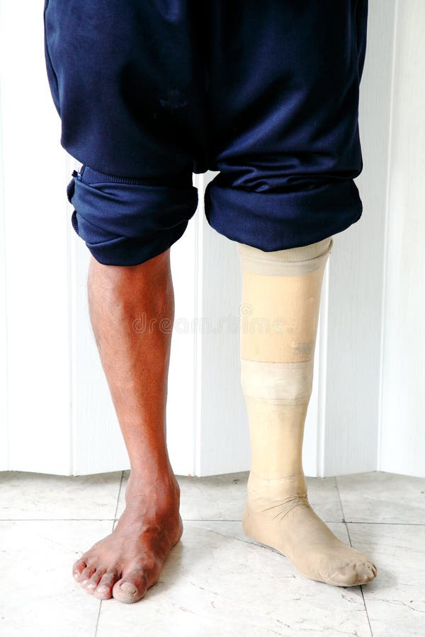 Prosthetic leg stock image. Image of healthcare, accident - 67399461