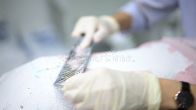 Technician Sculpting Plaster Cast for Socket at Prosthetic Factory ...