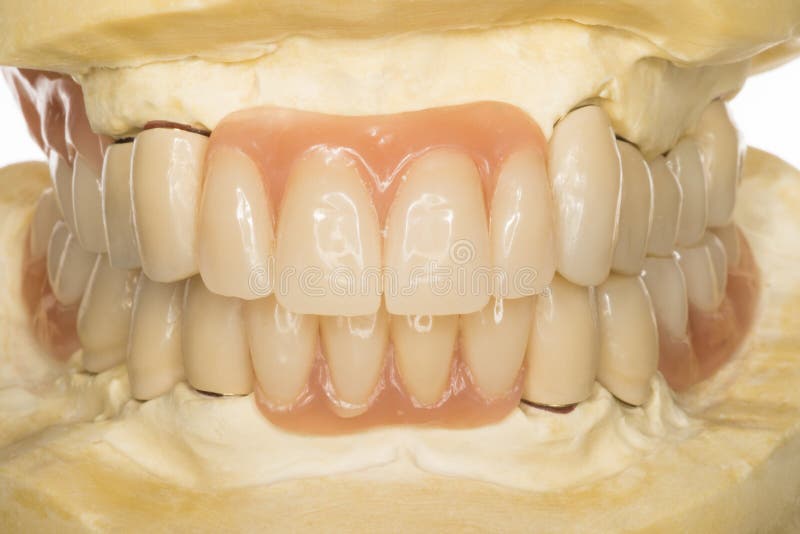 Protesi Dentaria, Incisivi Superiori Immagine Stock - Immagine di ...