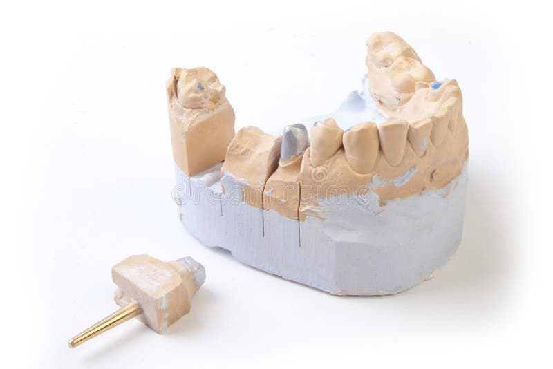 Protesi di odontoiatria immagine stock. Immagine di invecchiamento ...