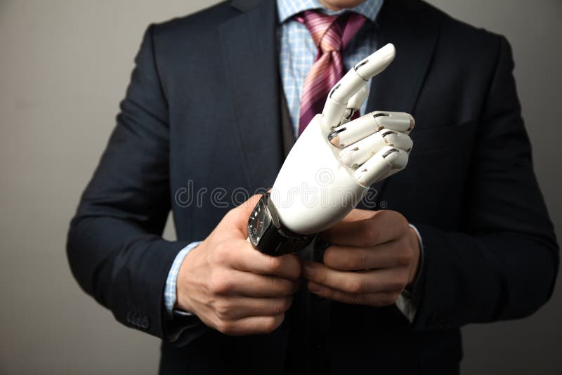 Bionic Medical Hand Prosthesis. Amputation of Arm Stock Image - Image ...