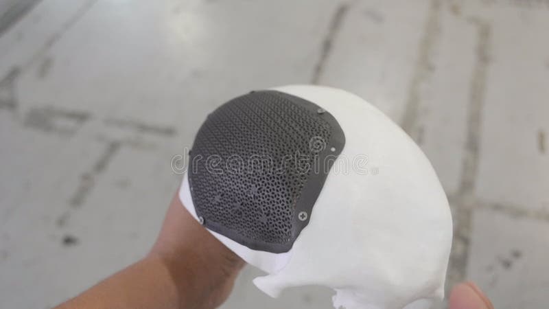 Prototype Human Skull Plastic Individual Patient-specific Cranial Plate ...