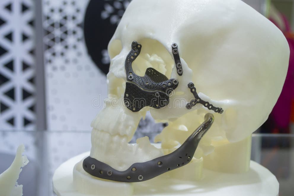 Prototype Human Skull from White Plastic Titanium Implants Form Plates ...