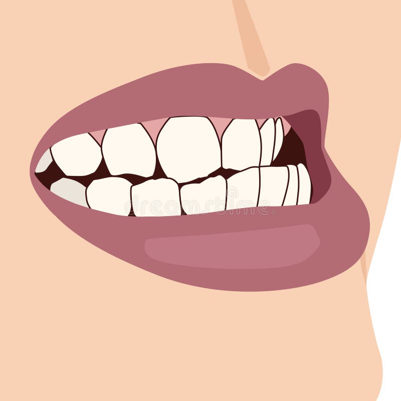 Protruding Lower Teeth Problem Lower Jaw, Illustration Close Up Stock ...
