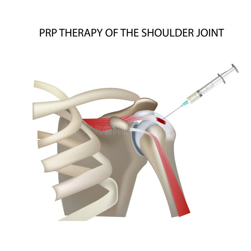 PRP Therapy of the Shoulder Joint, Vector Medical Illustration Stock ...