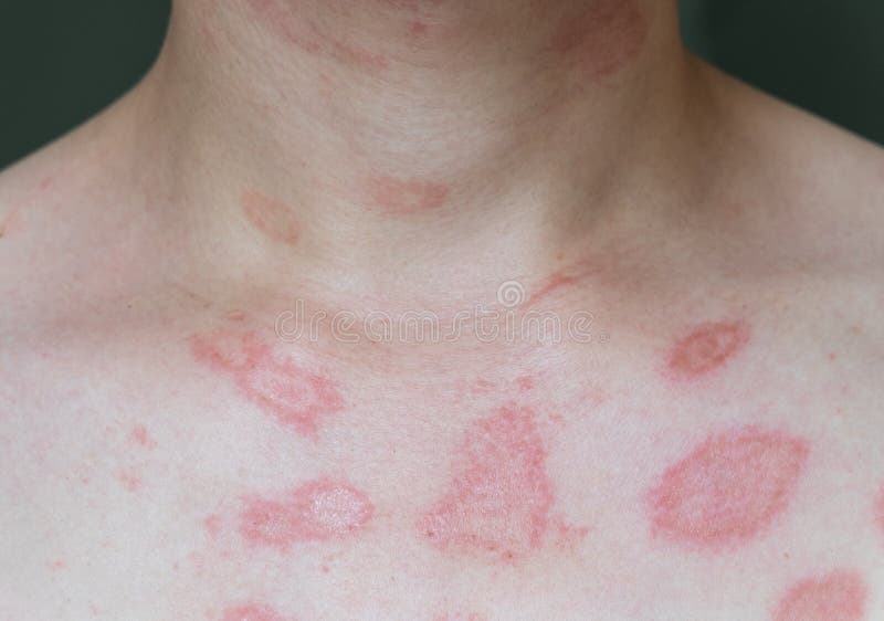 Prurido foto de stock. Imagem de rash, diagnóstico, hemorrhage - 7984250