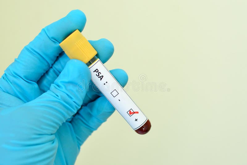 PSA positive stock photo. Image of medicine, cancer, tube - 55646866
