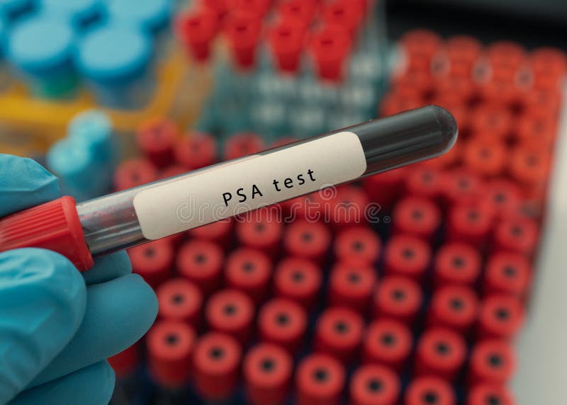 PSA Test Result with Blood Sample Tube Stock Image - Image of gland ...