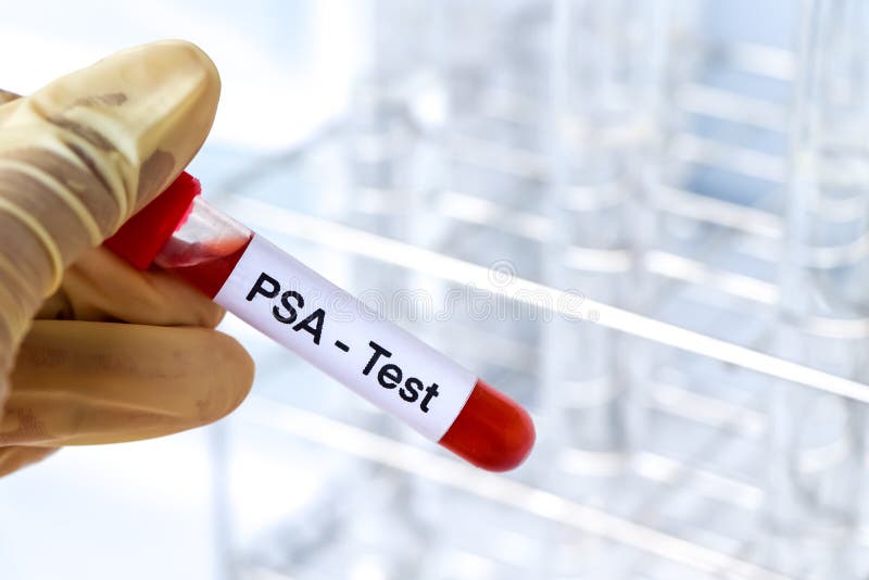 PSA Test To Look for Abnormalities from Blood Stock Image - Image of ...