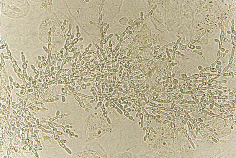 Pseudohyphae And Budding Yeast Cells In Patient Urine Stock Photo ...