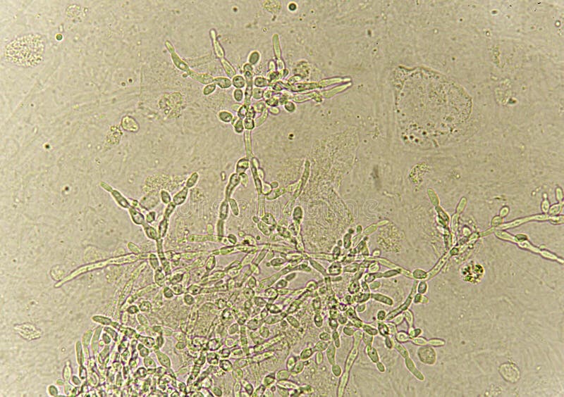 Pseudohyphae And Budding Yeast Cells In Urine Stock Image - Image of ...
