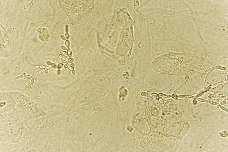 Pseudohyphae Und Anstehende Hefezellen Im Urin Stockfoto - Bild von ...
