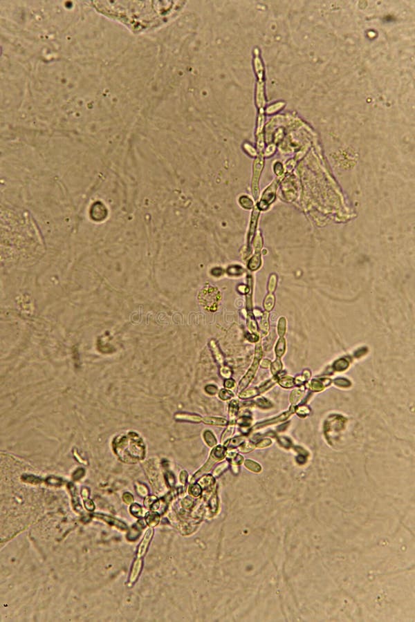 Pseudohyphae Und Anstehende Hefezellen Im Urin Stockfoto - Bild von ...