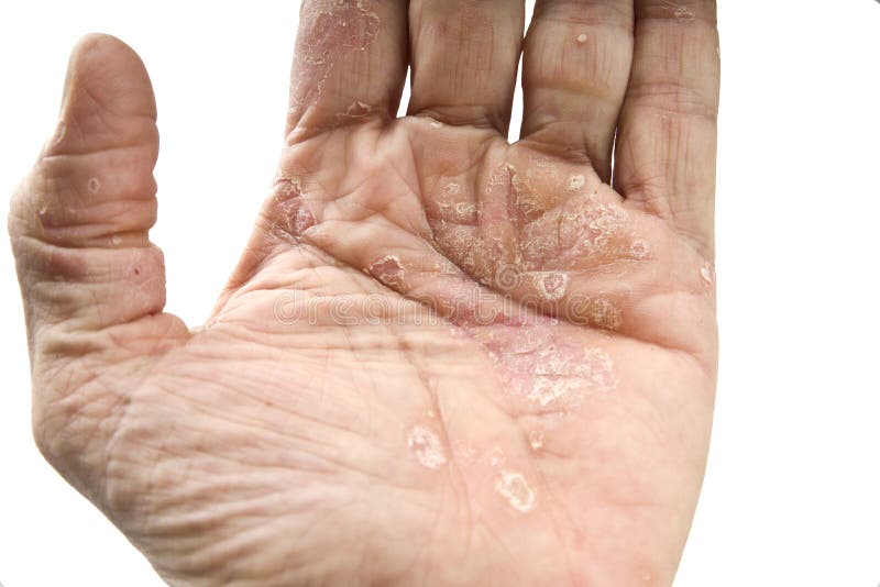 Psoriasi, Malattia Della Pelle Fotografia Stock - Immagine di prurito ...