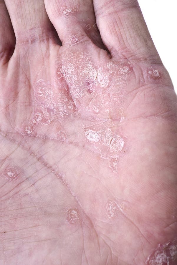 Psoriasi, Malattia Della Pelle Fotografia Stock - Immagine di malattia ...