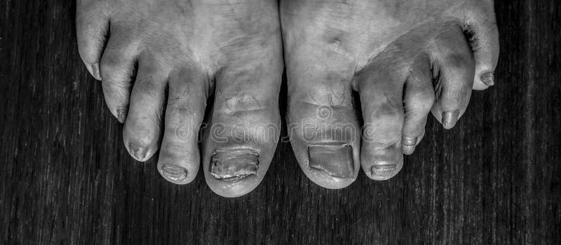 Psoriasi nel piede immagine stock. Immagine di cura - 129728275