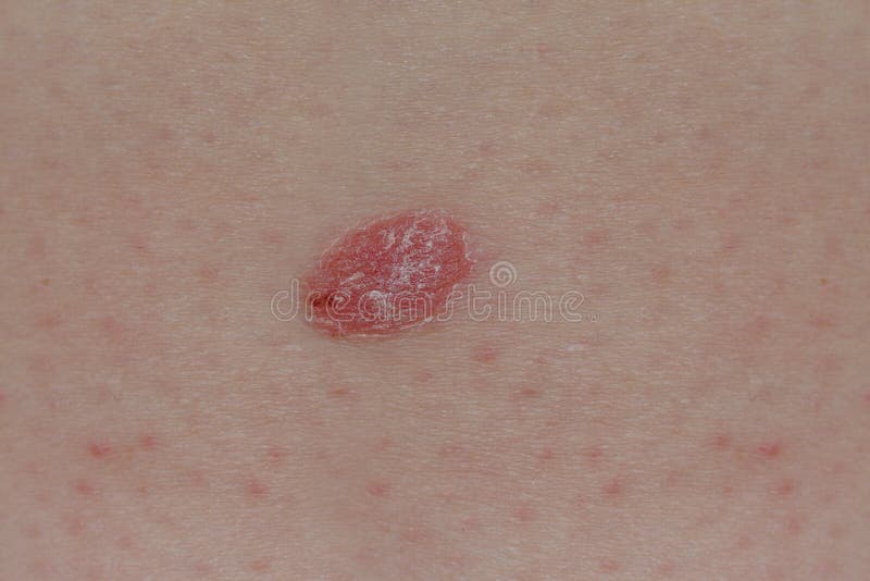 Psoriasis sur le bras photo stock. Image du écaillement - 40723078