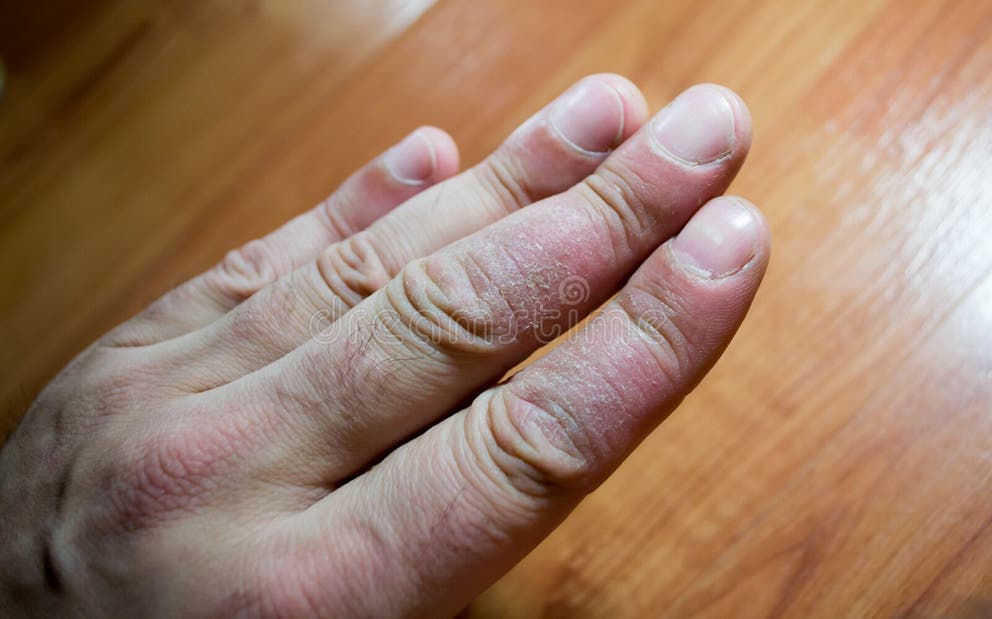 Psoriasis image stock. Image of rouge, commun, adulte - 49976911