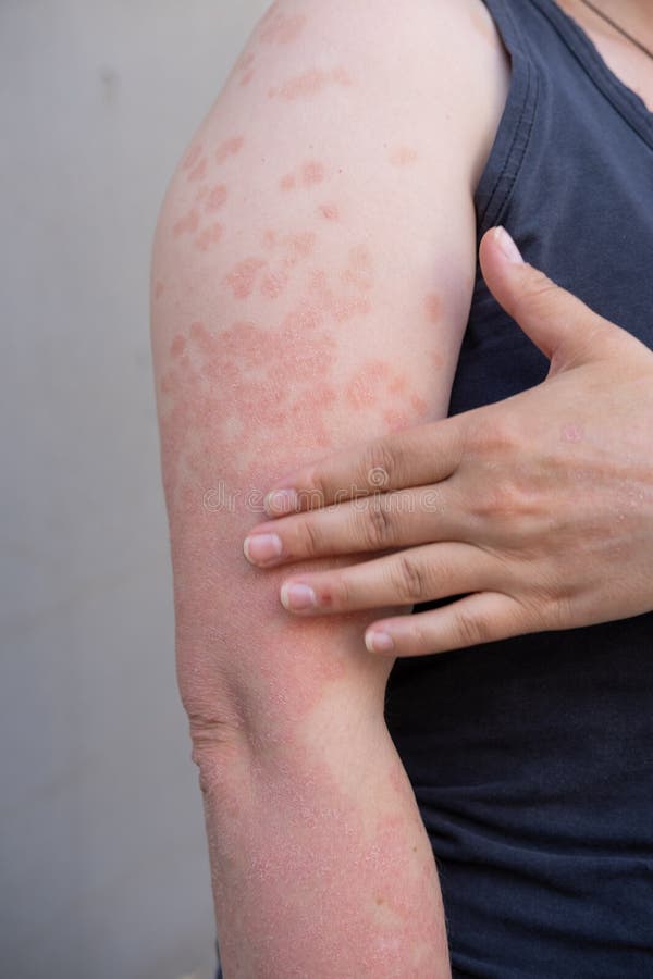 Psoriasis on the Body, Arm and Elbow. Close-up. Stock Photo - Image of ...