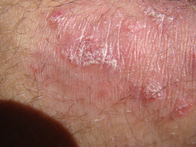 Psoriasis stock photo. Image of wound, skin, lymphocytes - 93728280