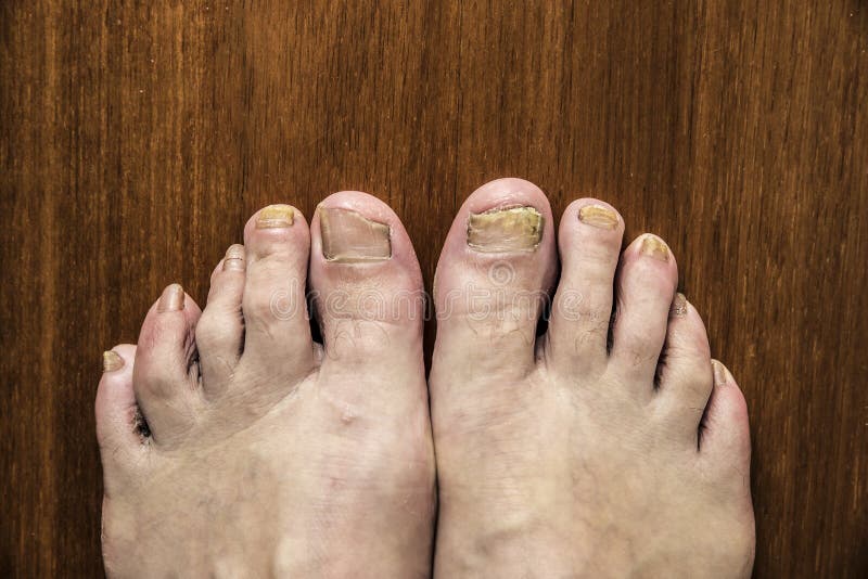 Psoriasis dans le pied image stock. Image du éruption - 91802209