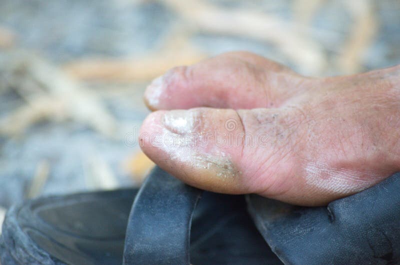 Psoriasis, Dermatite Callosité De Pied Photo stock - Image du femme ...