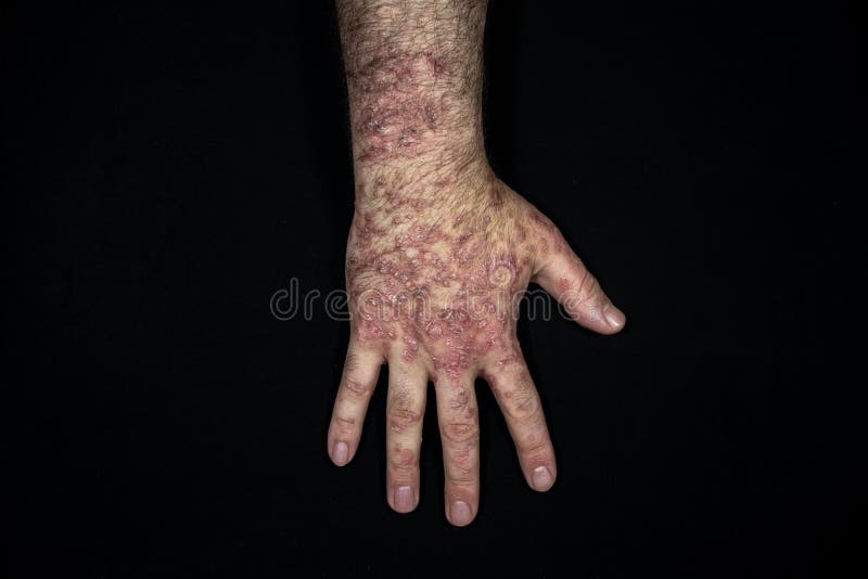 Psoriasis Eczema on the Hand Isolated on Black Background. Stock Photo ... Psoriasis Eczema on the Hand Isolated on Black Background. Stock Photo ...