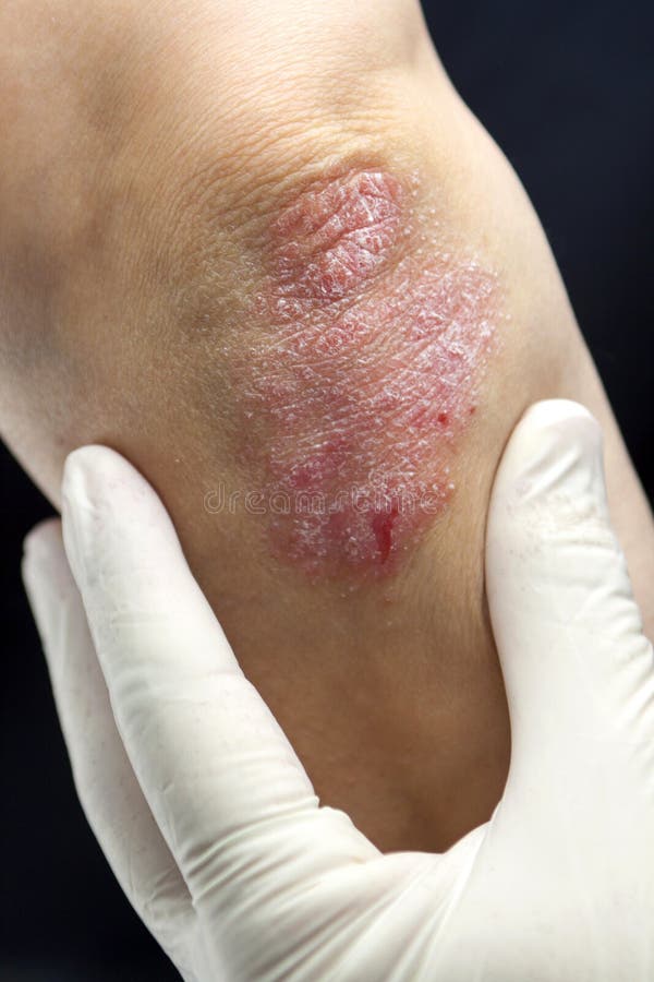 Psoriasis on elbows stock photo. Image of care, dermatitis - 41100444