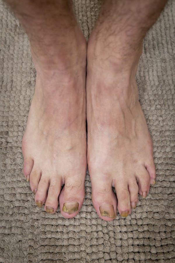 Psoriasis en el pie imagen de archivo. Imagen de cuidado - 160924365