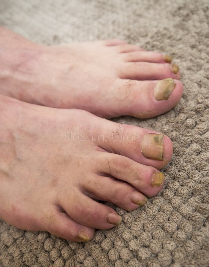 Psoriasis en el pie imagen de archivo. Imagen de salud - 129728275