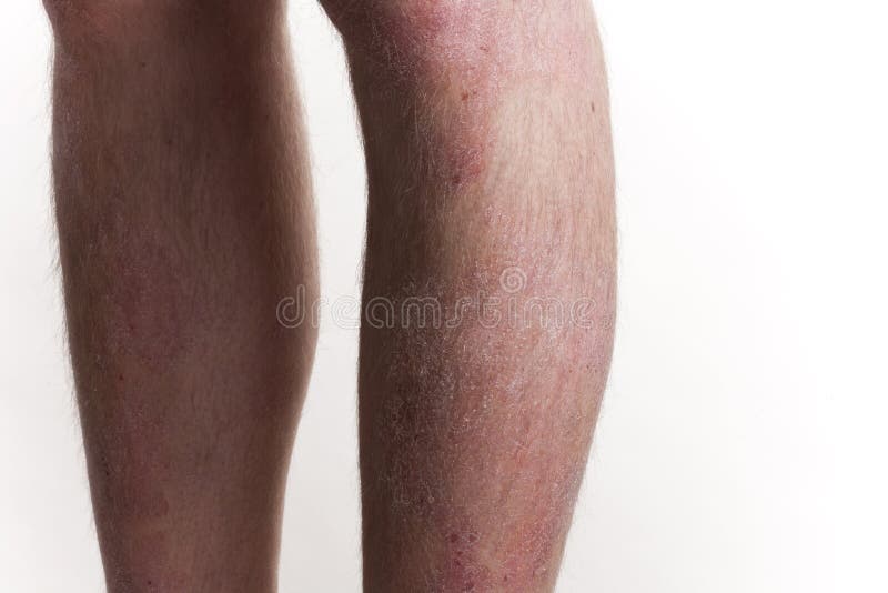 Psoriasis en las piernas foto de archivo. Imagen de seco - 23055564