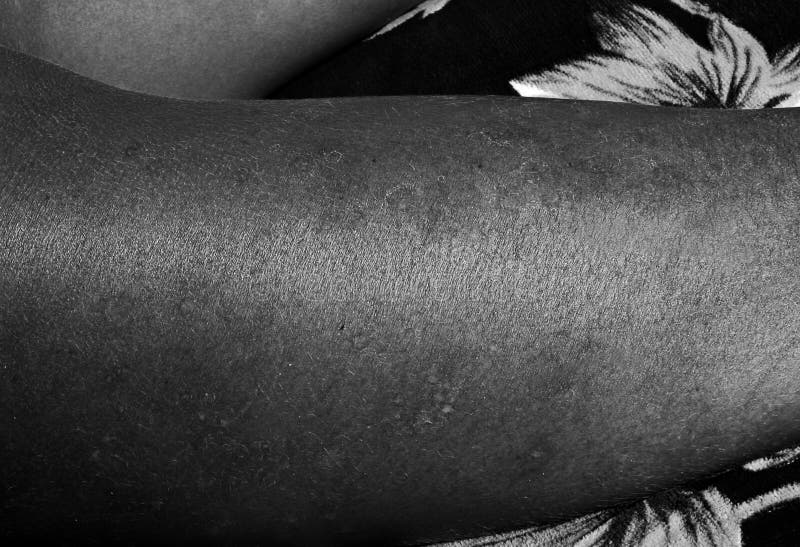 Psoriasis girl leg stock image. Image of person, white - 172257477