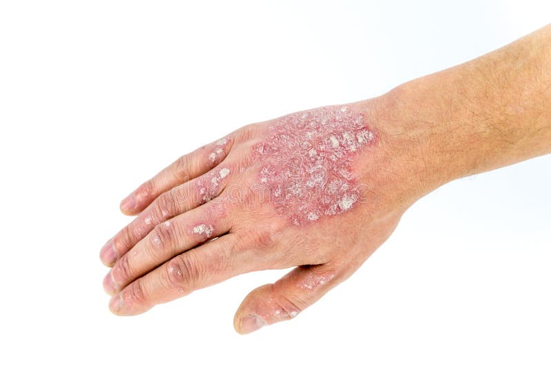 Psoriasis On The Hand Isolated On White Stock Photo - Image of ...