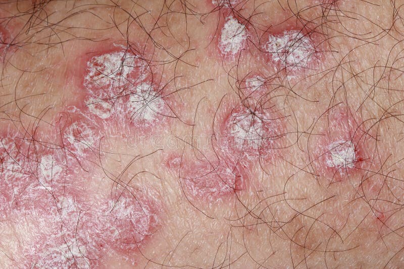 Psoriasis lesions stock photo. Image of petal, hand - 248541430