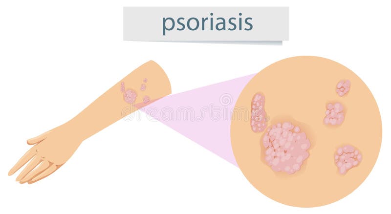 Diagramme Humain De Peau Avec La Normale Et Le Psoriasis Illustration ...