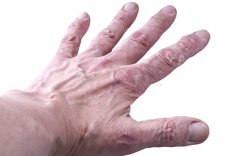 Psoriasis, Maladie De La Peau Image stock - Image du doigts, paume ...