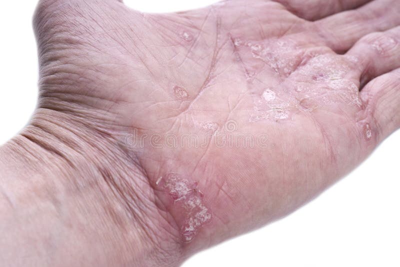 Psoriasis Le Psoriasis Est Une Maladie Auto-immune Qui Affecte La Peau ...