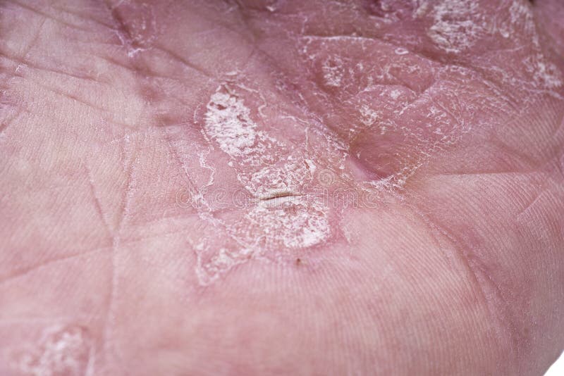 Psoriasis, Maladie De La Peau Photo stock - Image du paume, fermer ...