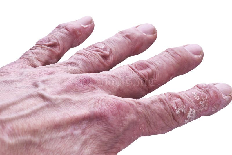 Psoriasis, Maladie De La Peau Photo stock - Image du santé, désordre ...