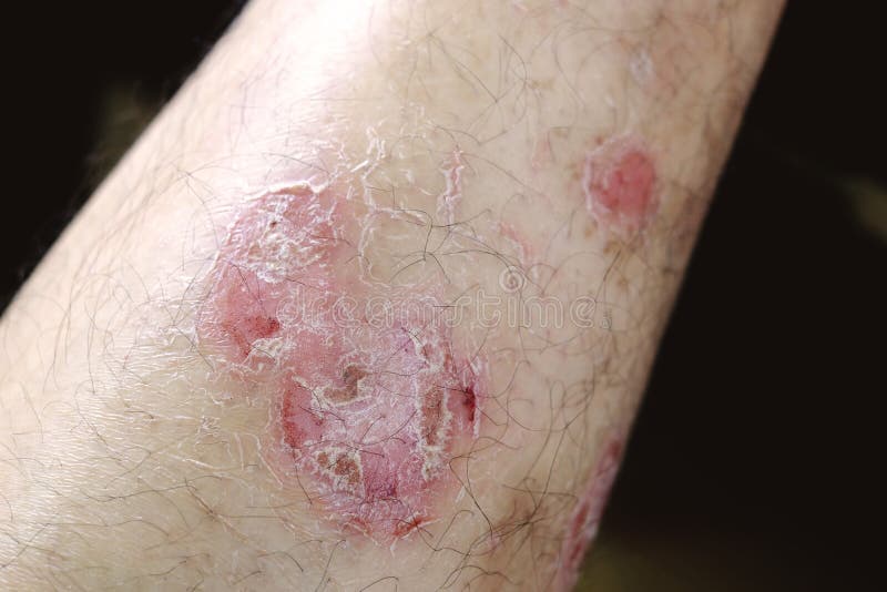 Psoriasis stock photo. Image of plaque, genetic, itchy - 97810532