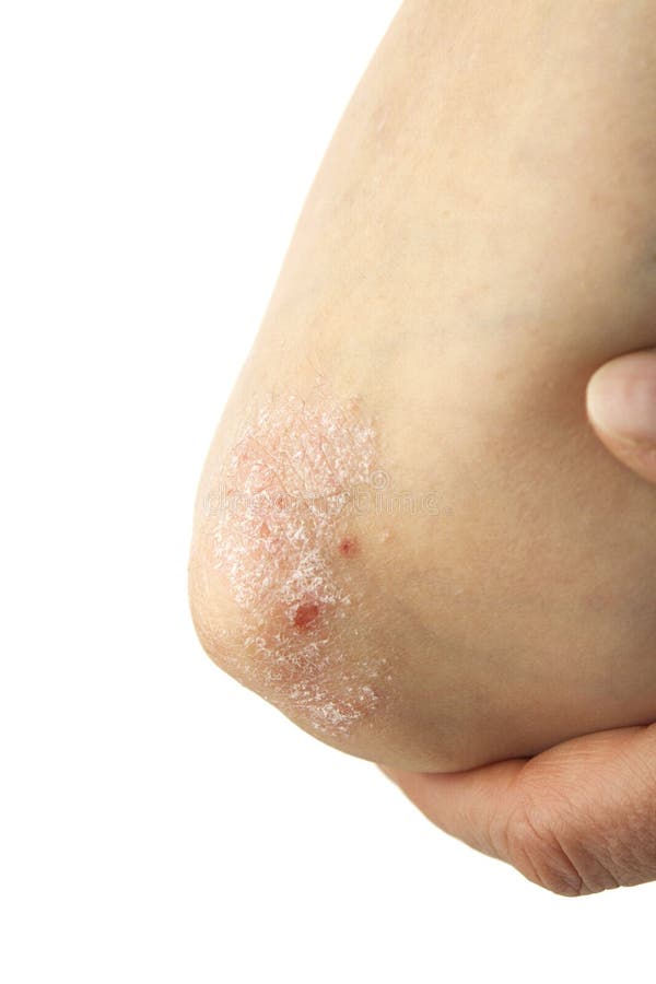 Psoriasis sur des coudes image stock. Image du problèmes - 41100431