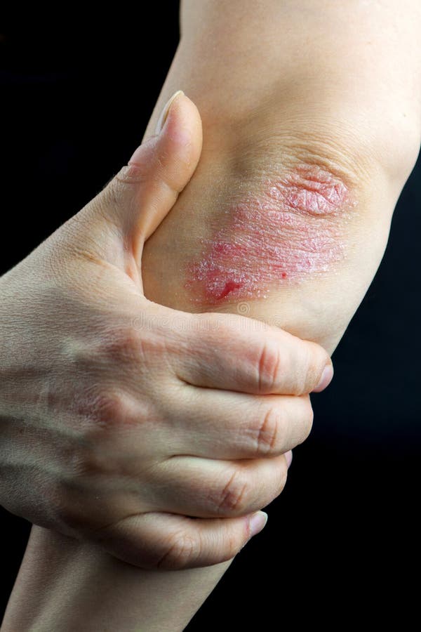 Psoriasis sur des coudes image stock. Image du problèmes - 41100431