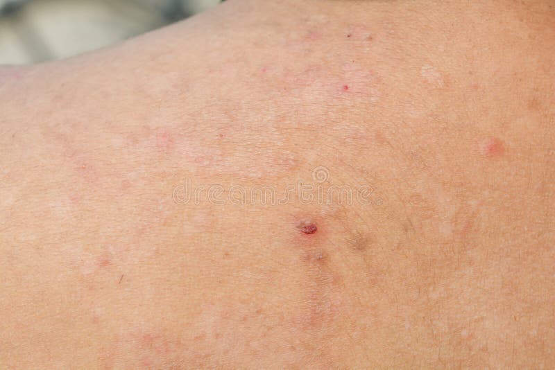 Psoriasis Sur La Dermatite De Peau, Problèmes De Peau Image stock ...