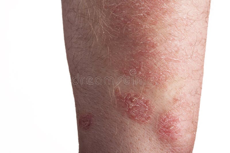 Psoriasis sur le bras photo stock. Image du eczéma, coude - 40723078