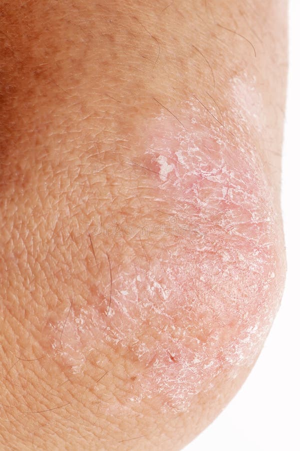 Psoriasis sur le bras photo stock. Image du écaillement - 40723078